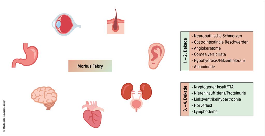 Morbus Fabry: wichtige Differenzialdiagnose der hypertrophen Kardiomyo ...