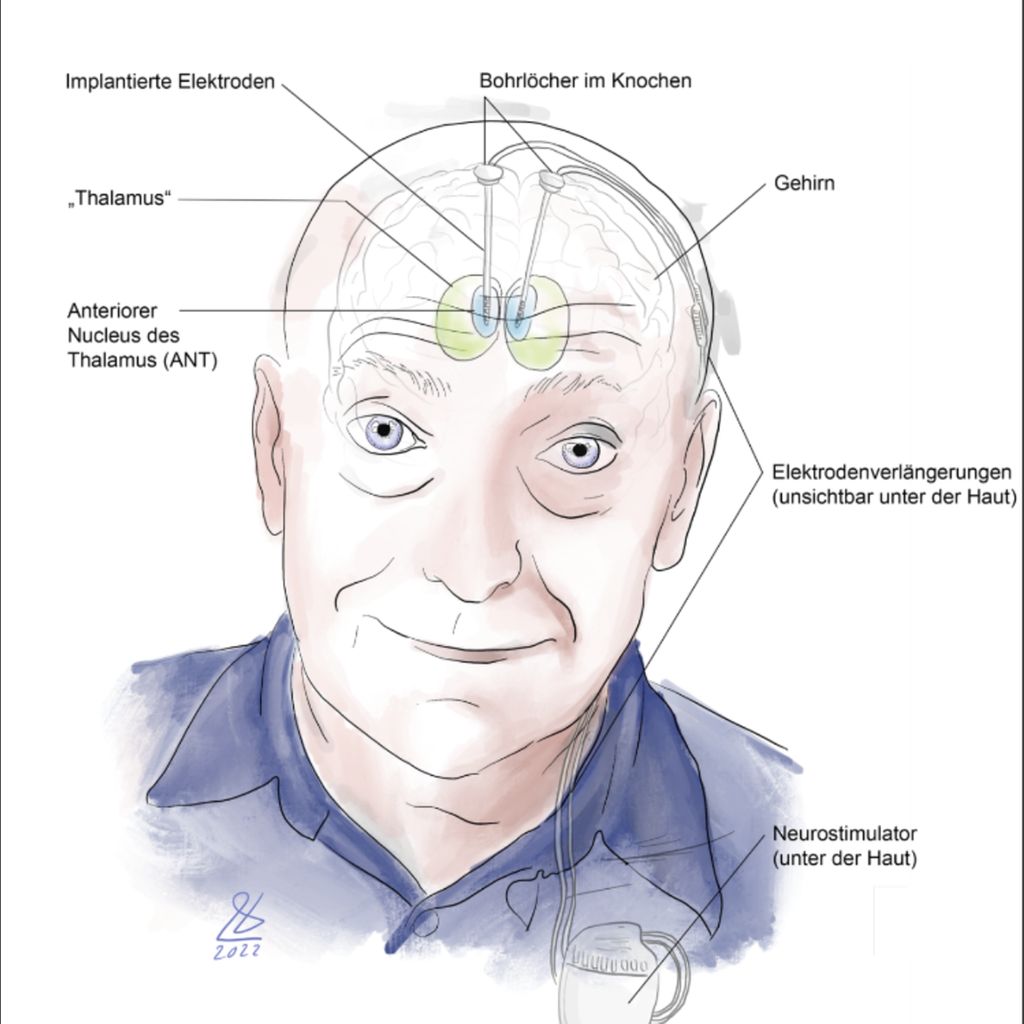Die tiefe Hirnstimulation bei Epilepsie - Neurologie - Universimed ...