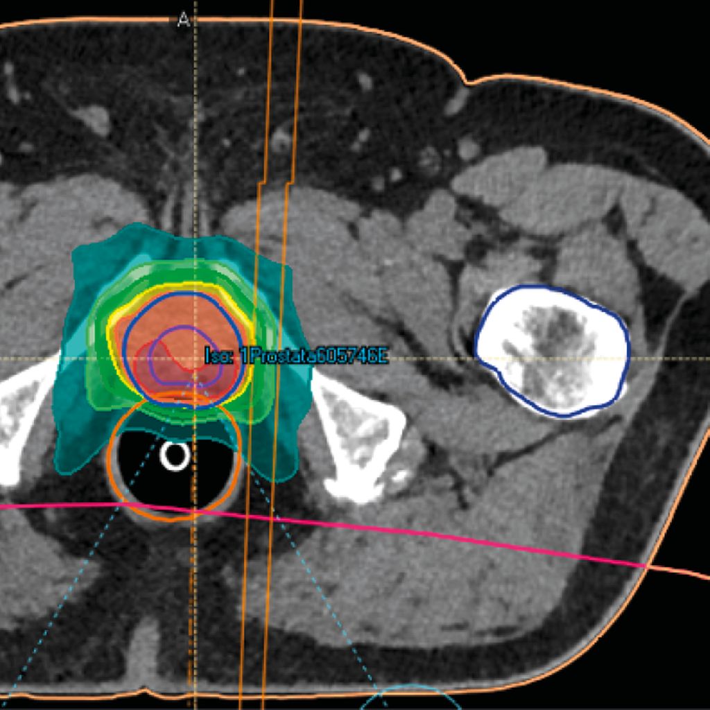 Radiotherapie beim Prostatakarzinom: Hochpräzision in allen Therapieas ...