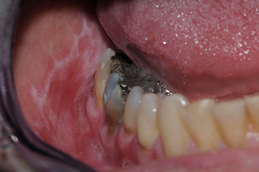 Differenzialdiagnose von Mundschleimhautläsionen - Dermatologie ...