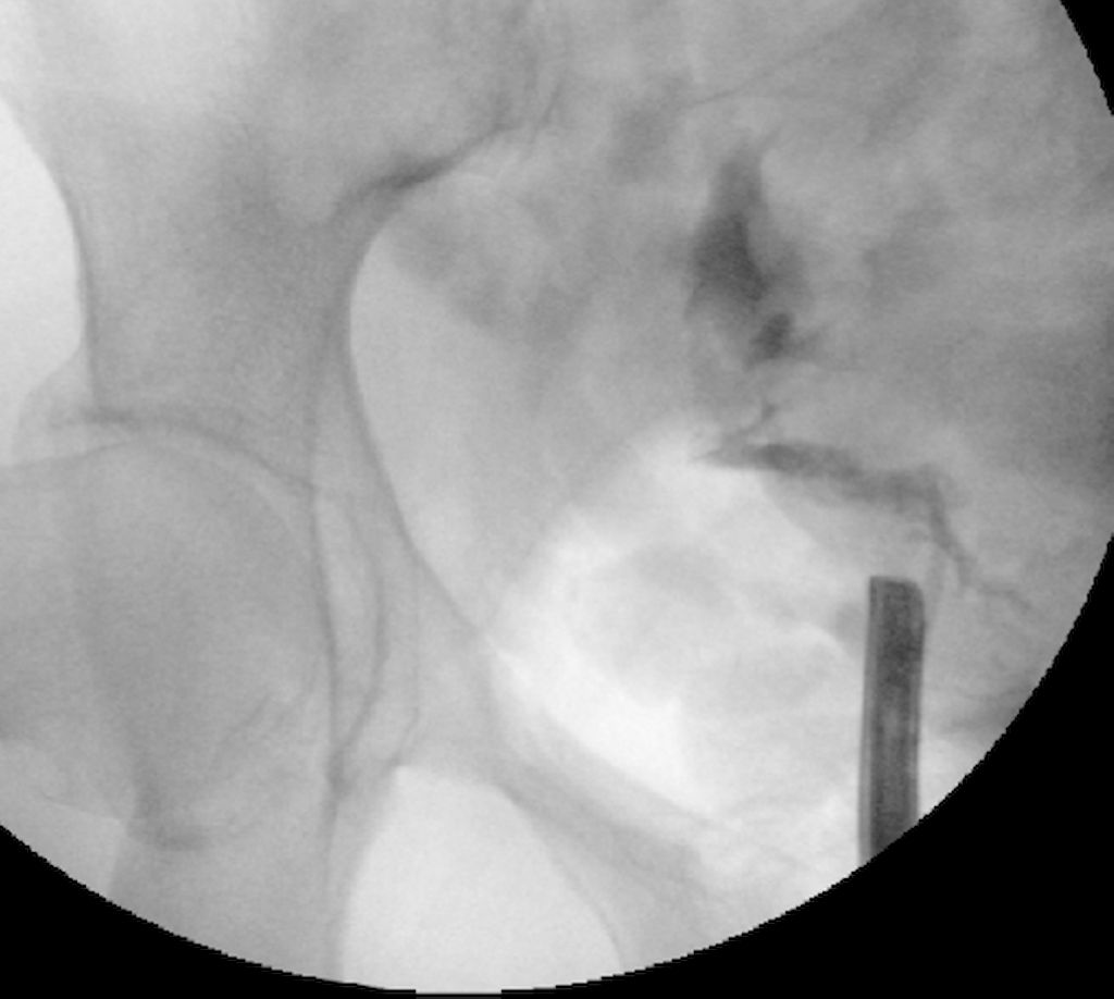 Ureterrekonstruktion – wann welche Technik? - Urologie & Andrologie ...