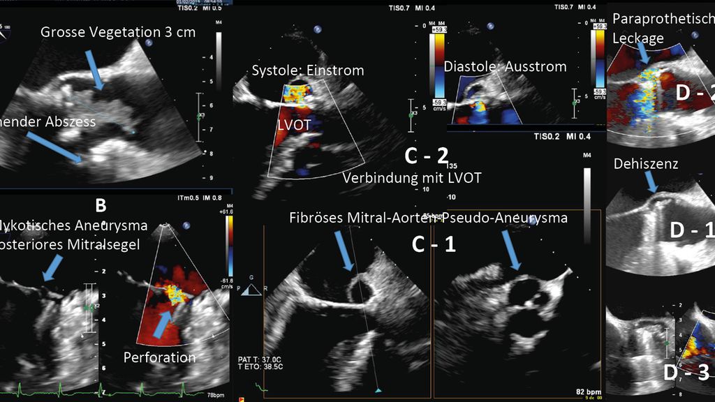 Infektiöse Endokarditis: eine ernst zu nehmende Erkrankung mit schwier ...