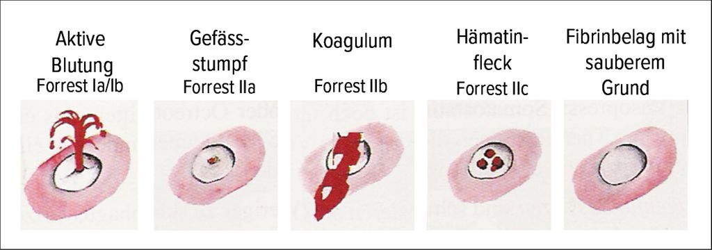 Gastroduodenale Ulkuskrankheit - Gastroenterologie - Universimed ...