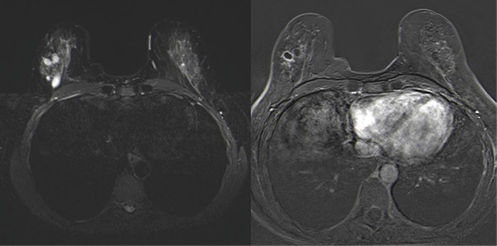 Zysten und Kalzifikationen in der Mamma - Gynäkologie & Geburtshilfe ...