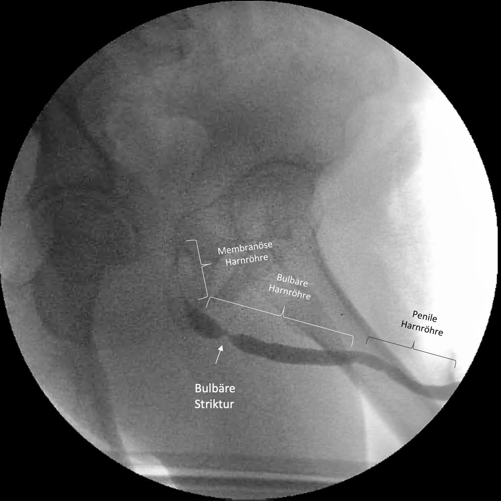 Die bulbäre Harnröhrenstriktur - Urologie & Andrologie - Universimed ...