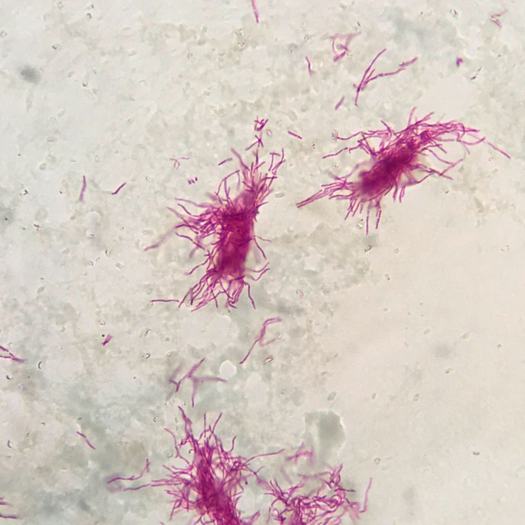 Nokardiose: ein Überblick - Infektiologie - Universimed - Medizin im Fokus