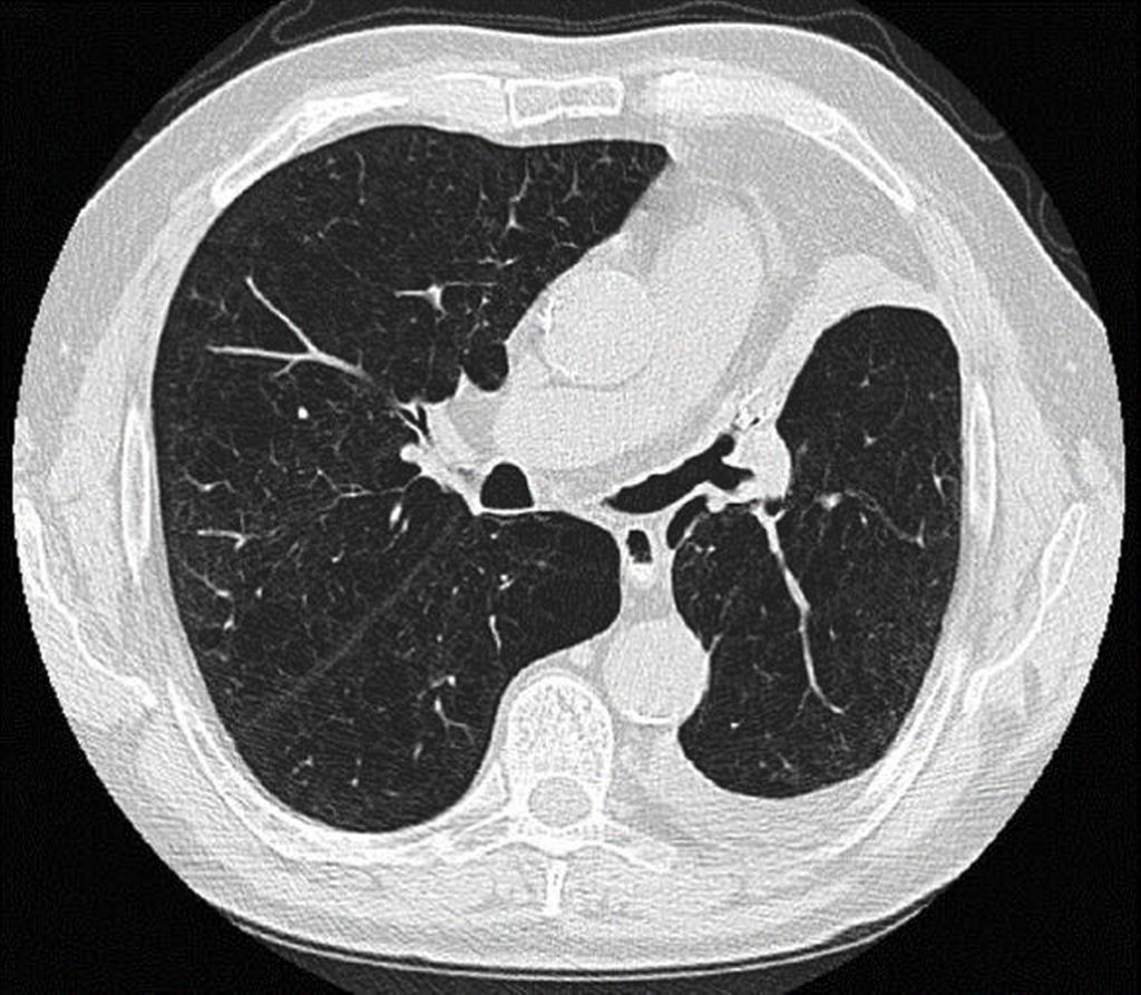 Interventionelle Pneumologie: Ventile bei COPD - Pneumologie ...