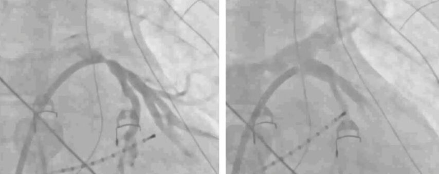 Pulmonalvenenstenosen nach Ablationsbehandlung von Vorhofflimmern ...