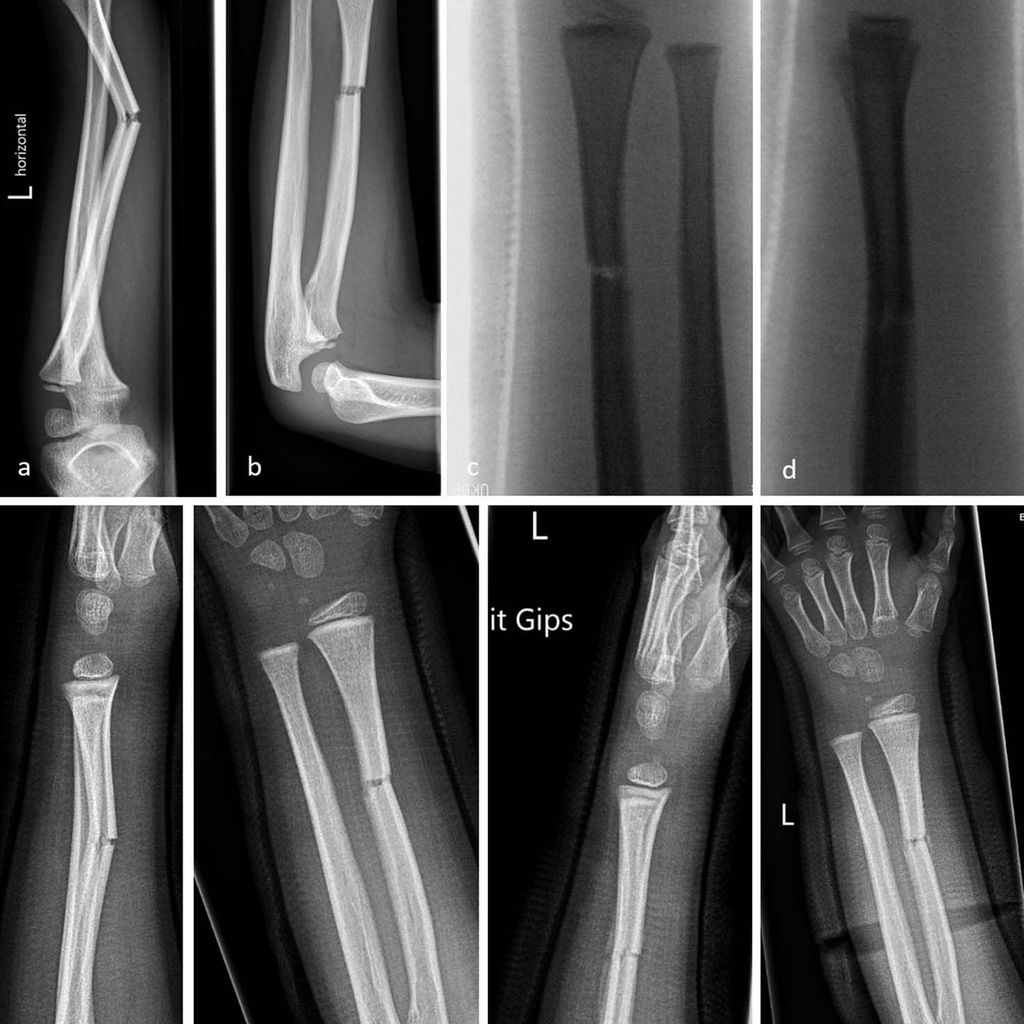 Gipskeilung bei pädiatrischen Frakturen - Orthopädie & Traumatologie ...