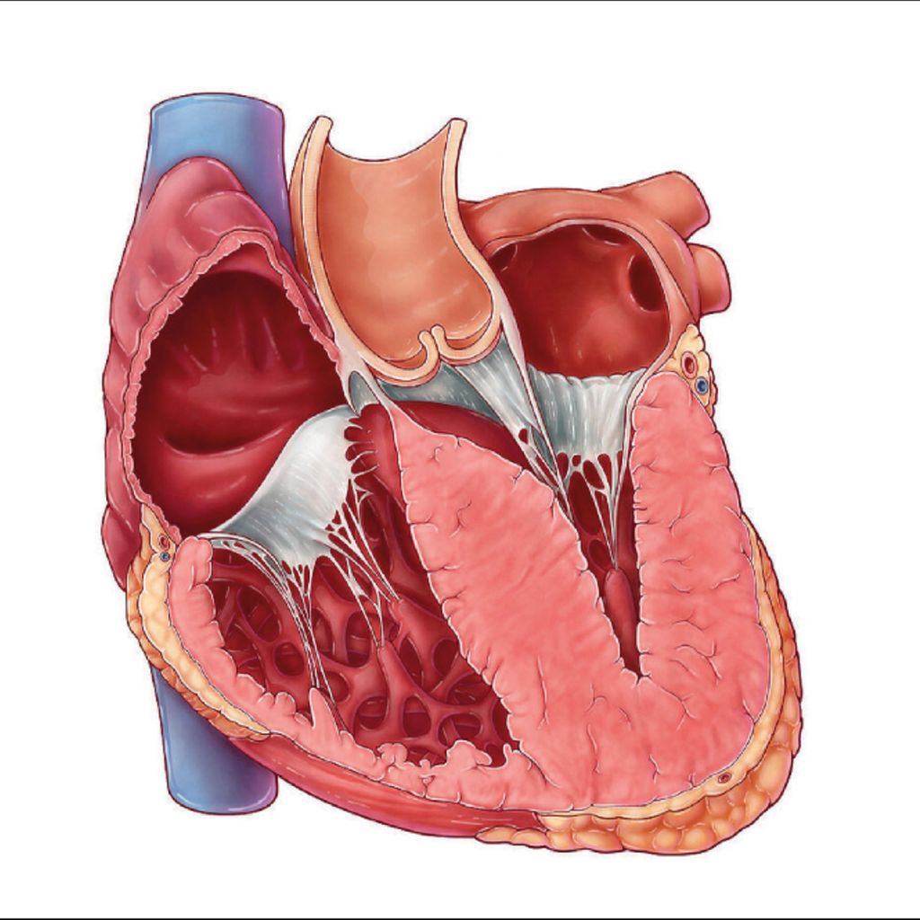 Hypertrophe Kardiomyopathie: häufiger als gedacht - Kardiologie ...