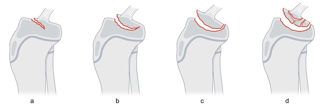 Kindliche Kreuzbandverletzungen - Orthopädie & Traumatologie ...