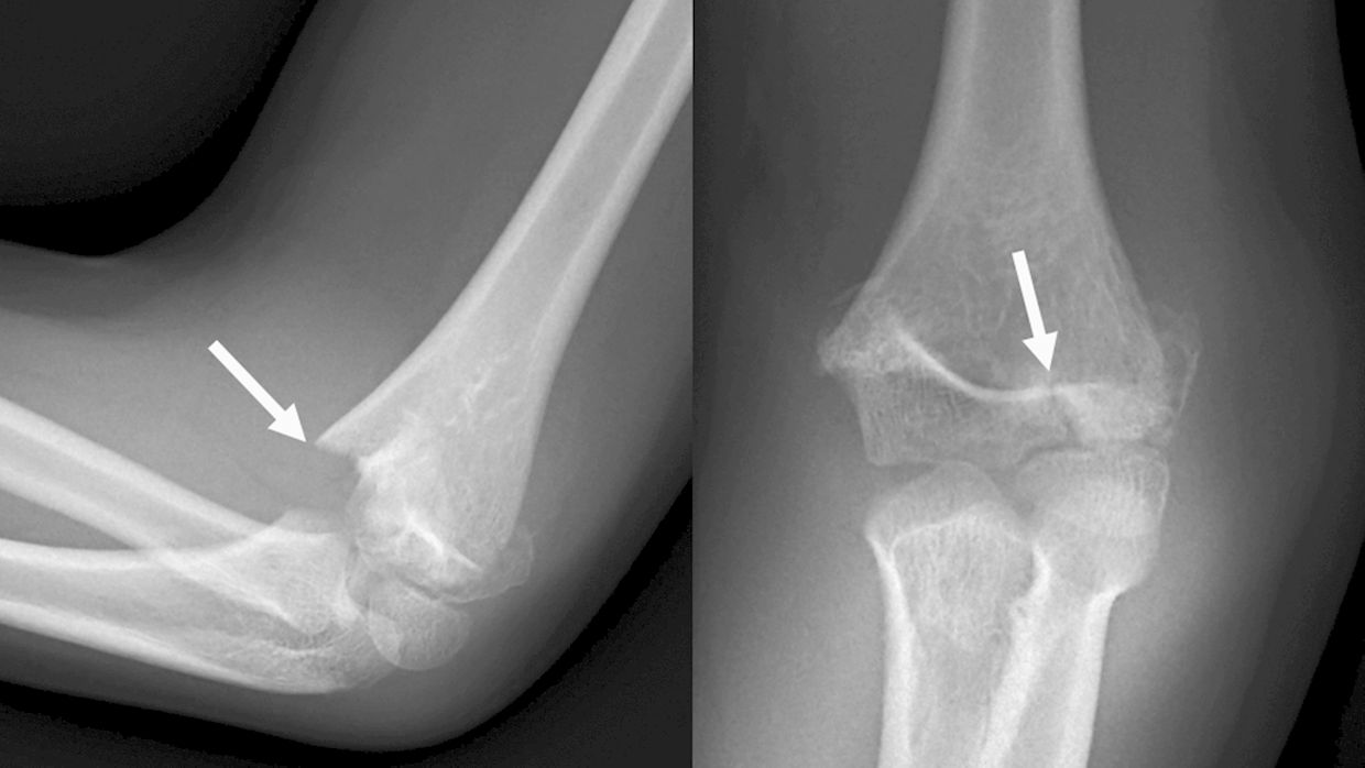 Bikondyläre distale Humerusfrakturen beim Kind und Jugendlichen: Was w ...