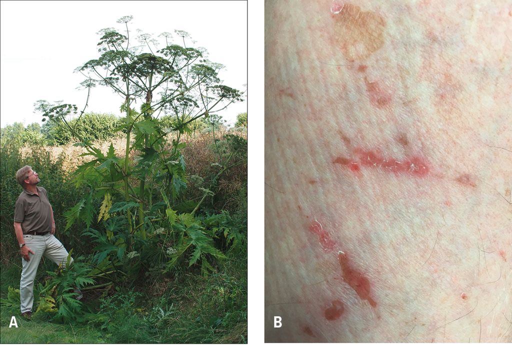 Toxische und allergische Reaktionen durch Pflanzen - Dermatologie ...