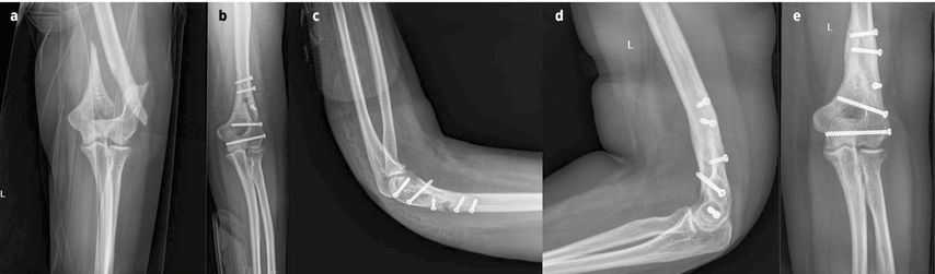 Bikondyläre distale Humerusfrakturen beim Kind und Jugendlichen: Was w ...
