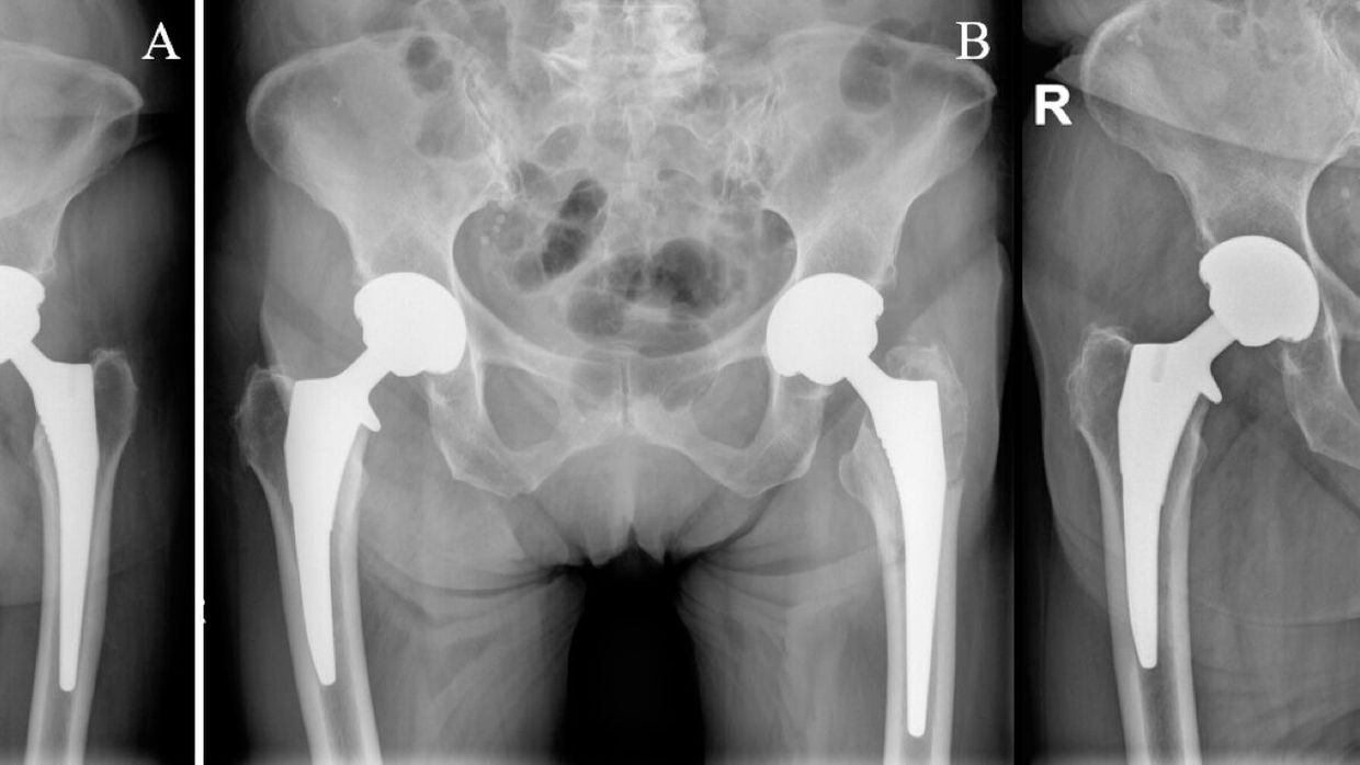 Kragendesign in der Hüftendoprothetik - Orthopädie & Traumatologie ...