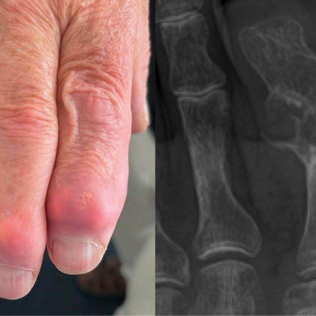 Gicht und Hyperurikämie - Allgemeine Innere Medizin - Universimed ...