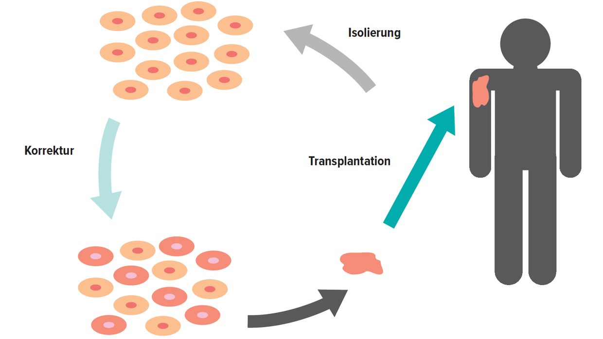 Gentherapeutische Ansätze für die Epidermolysis bullosa - Dermatologie ...