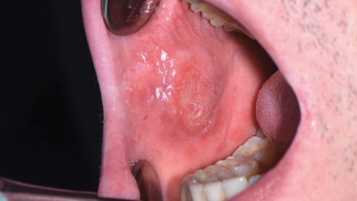 Die Mundschleimhaut – Paradebeispiel interdisziplinärer Zusammenarbeit ...