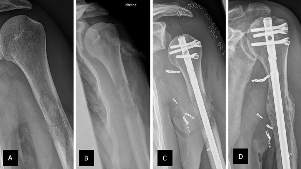 Der proximale Humerusersatz bei malignen Knochentumoren - Orthopädie & Traumatologie ...