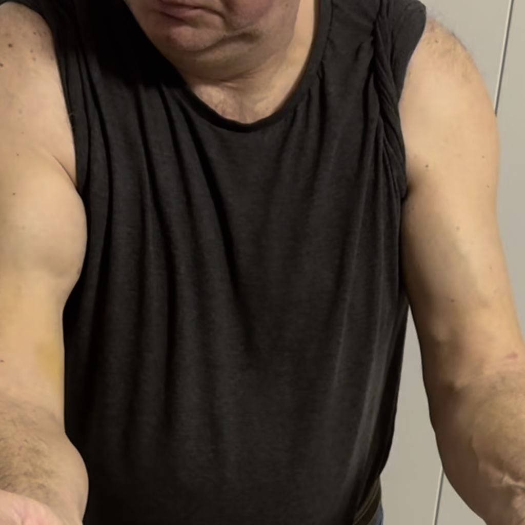 Die operative Therapie der distalen Bizepssehnenruptur - Orthopädie ...