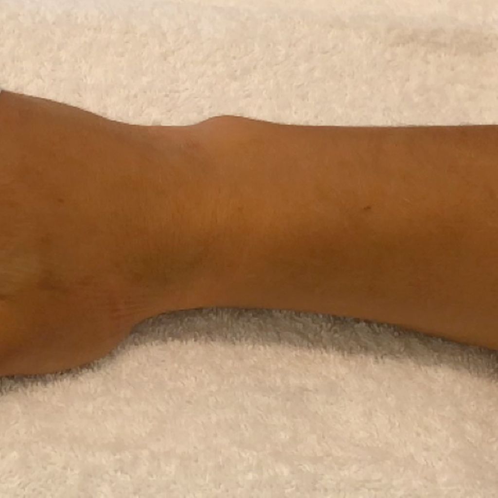 Behandlung von Strecksehnenverletzungen an der Hand - Orthopädie ...