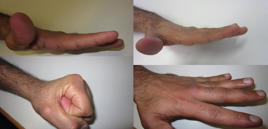 Behandlung von Strecksehnenverletzungen an der Hand - Orthopädie ...