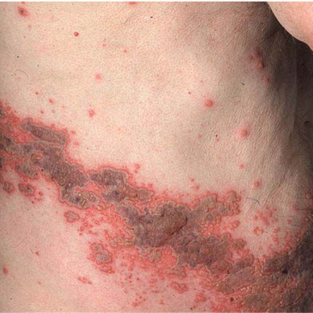 Tableau clinique, traitement et prévention des infections par le VZV ...