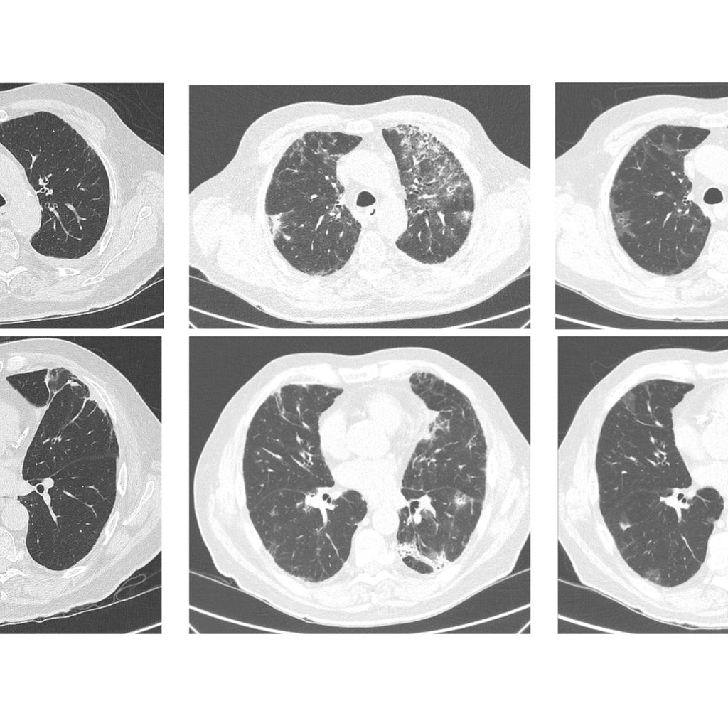 Pulmonale Nebenwirkungen Von Immuncheckpoint Inhibitoren Pneumologie pulmonale-nebenwirkungen-von-immuncheckpoint-inhibitoren-pneumologie