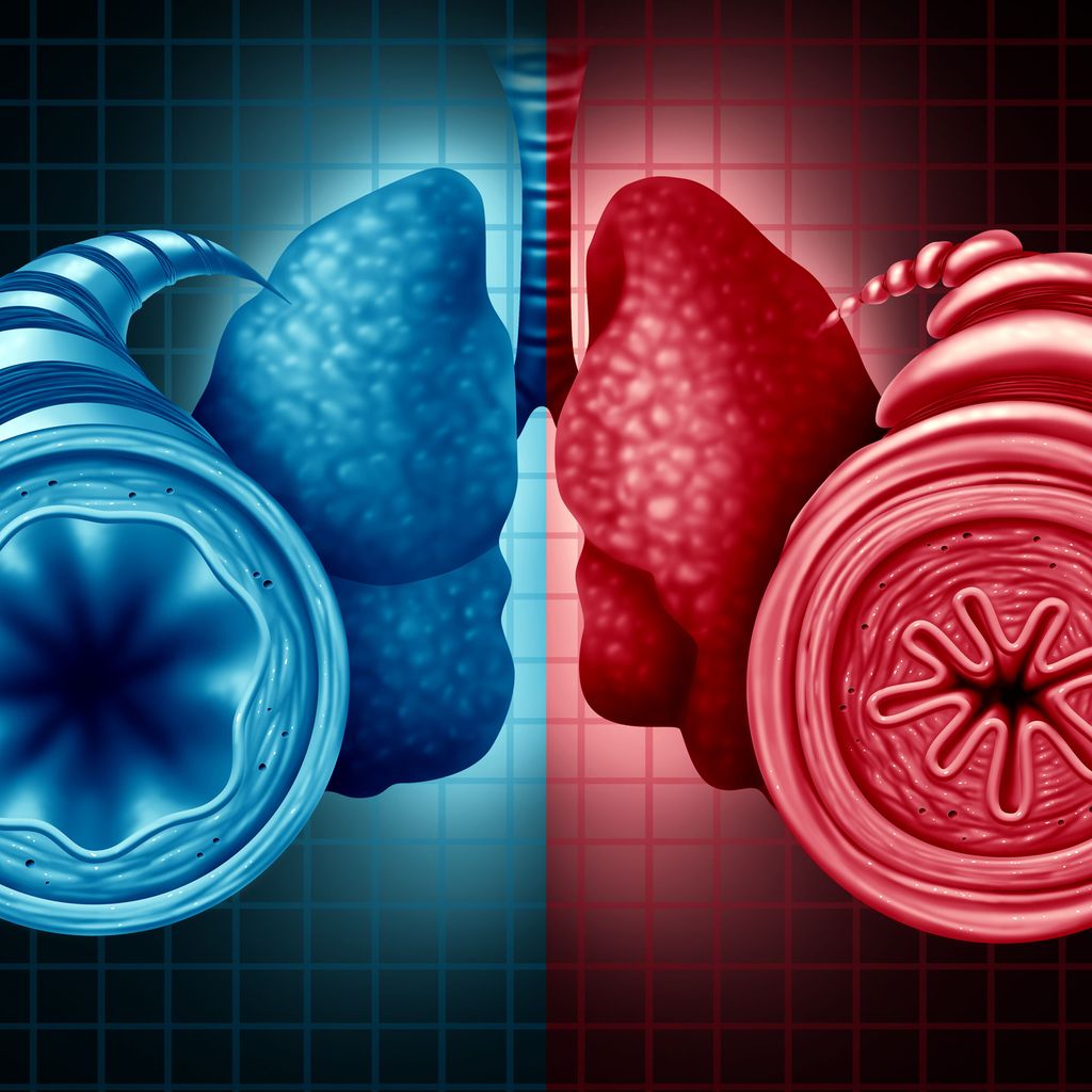 Asthma: Therapieziel Remission ist realistisch - Pneumologie ...