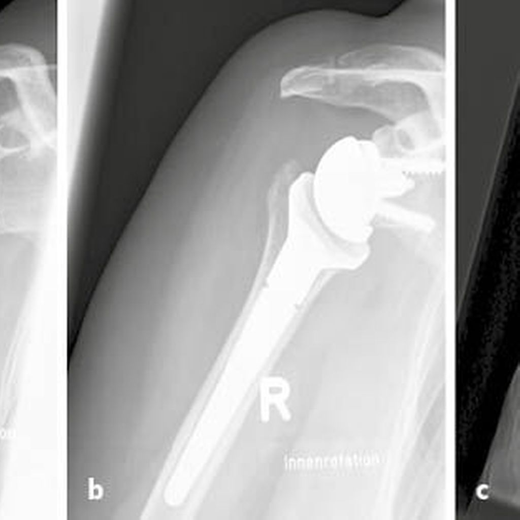 Evidence-based long-term results after reverse shoulder arthroplasty i ...