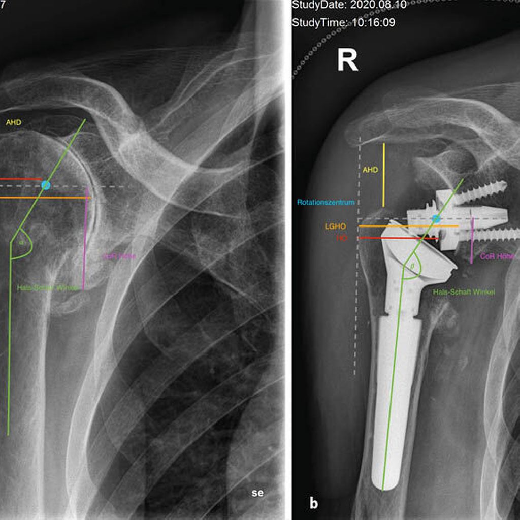 Inverse Schulterprothese bei Glenoiddefekt mit augmentierter Basisplat ...