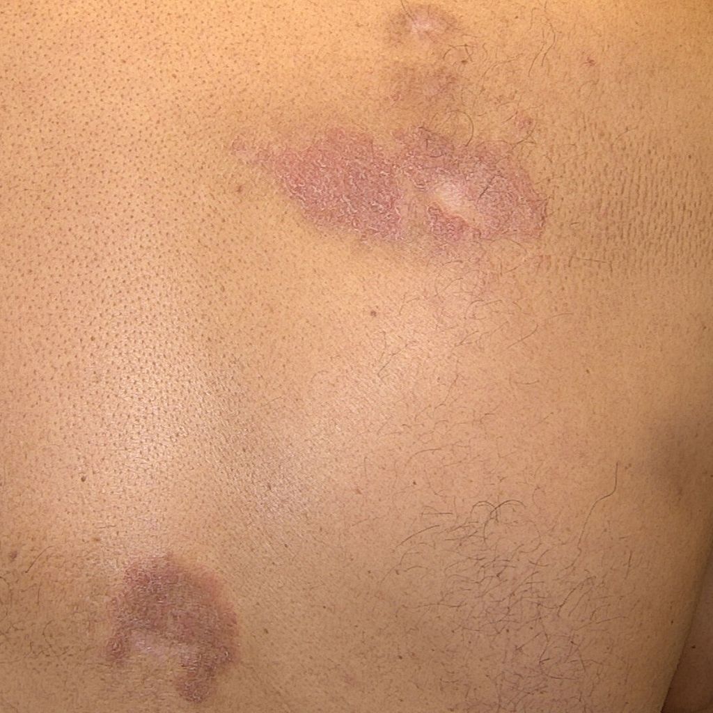 Notalgia paraesthetica: eine dermatologische Herausforderung ...