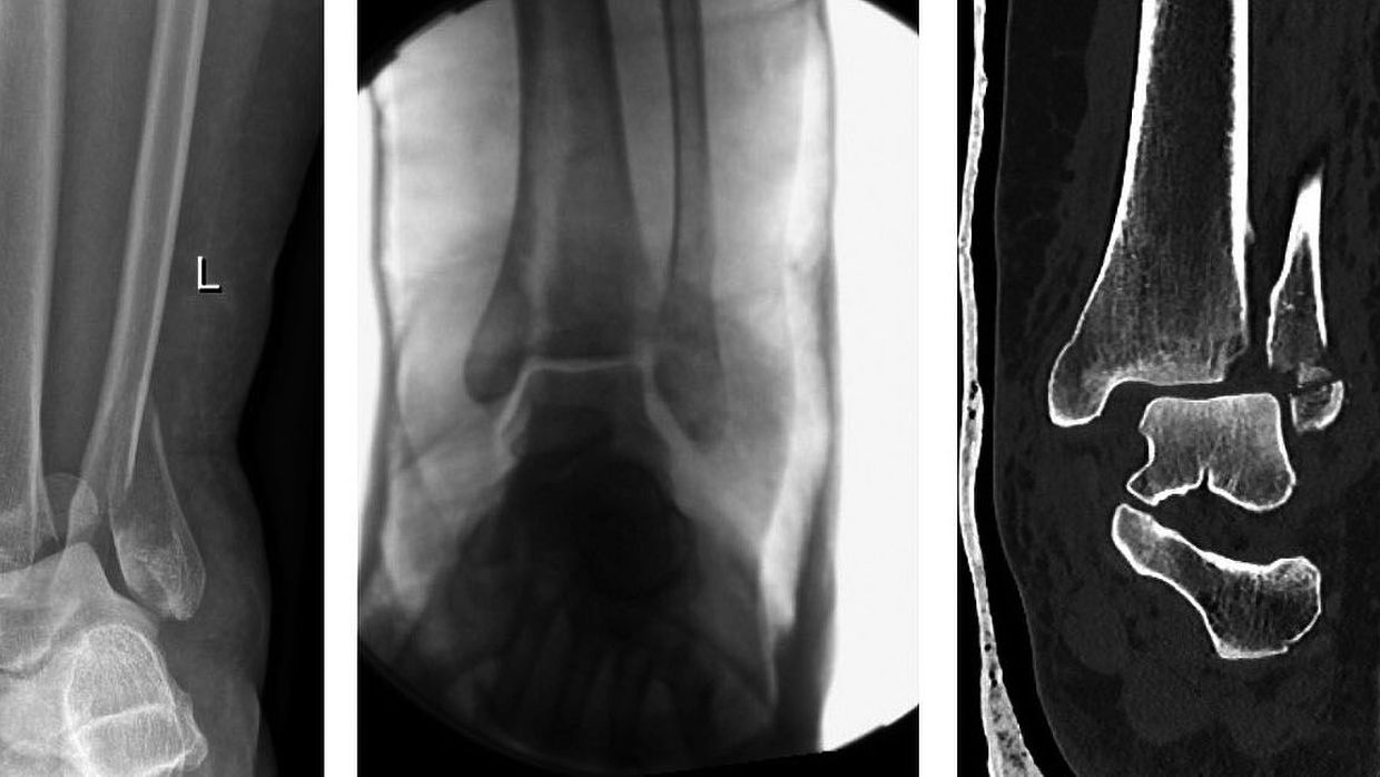 Temporäre Immobilisierung im Gips versus Fixateur externe bei OSG-Luxa ...