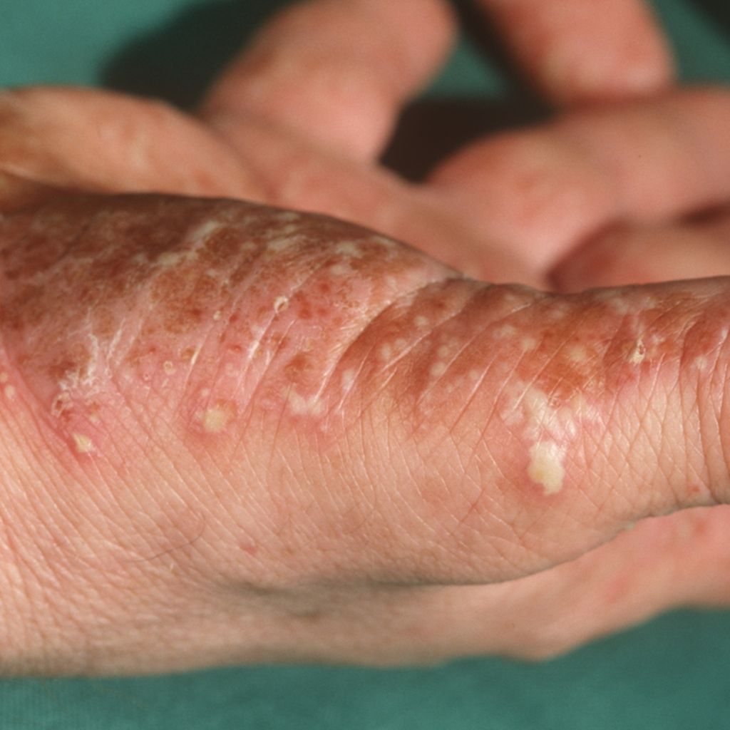 Das weite klinische Spektrum der Psoriasis pustulosa - Dermatologie ...