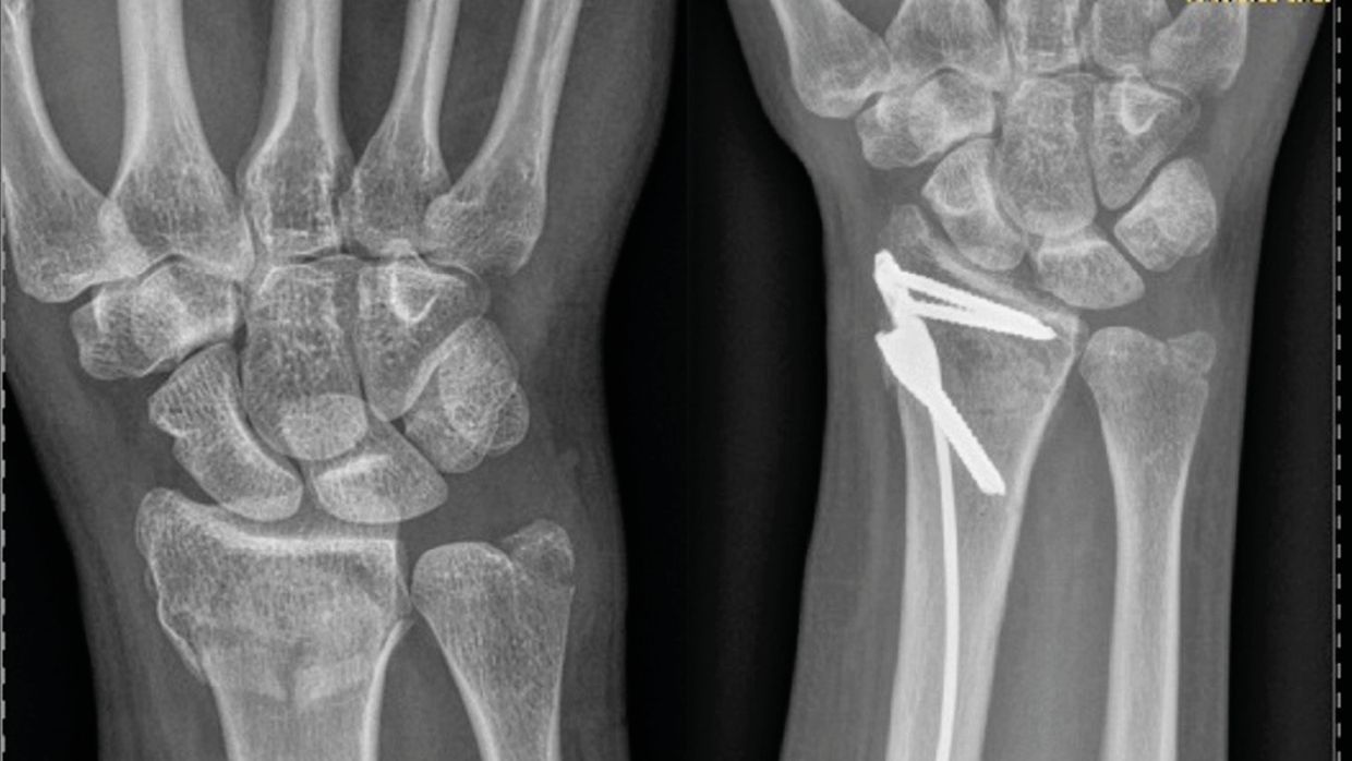 Intramedulläre Nagelung der distalen Radiusfraktur - Orthopädie ...