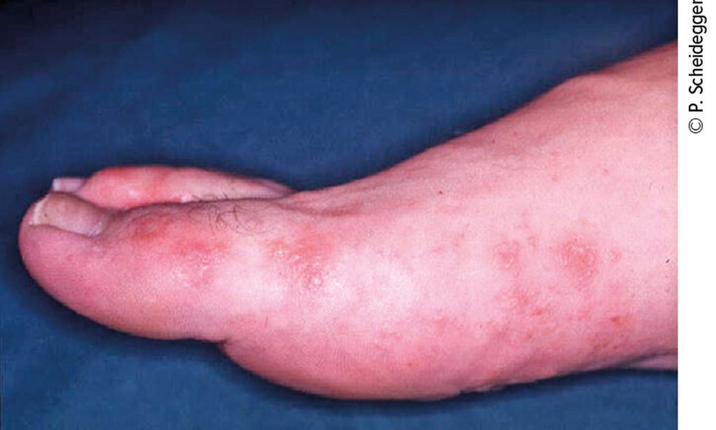 Mycose – ou autre affection? - Universimed - Medizin im Fokus