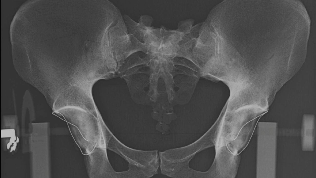 «Pelvic tilt» bei verschiedenen Pathomorphologien der Hüfte ...