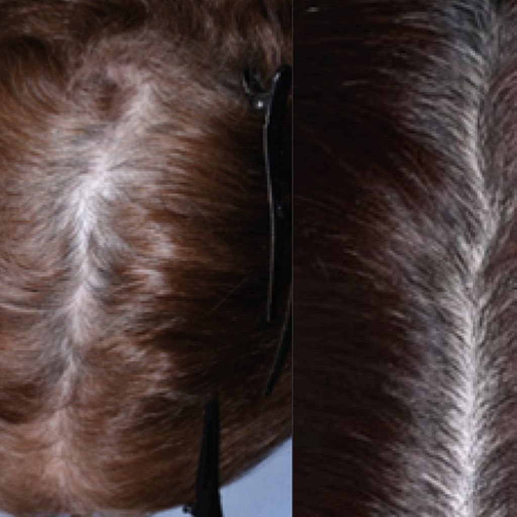 Haarausfall im Rahmen von onkologischen Systemtherapien - Dermatologie ...