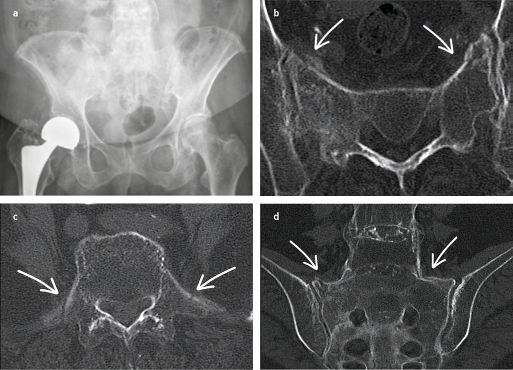 Osteoporoseassoziierte Fragilitätsfrakturen des Beckenrings ...