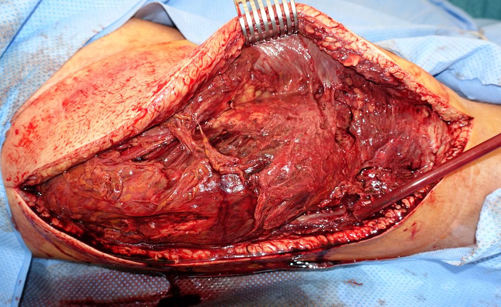 Nekrotisierende Weichteilinfektionen - Orthopädie & Traumatologie ...