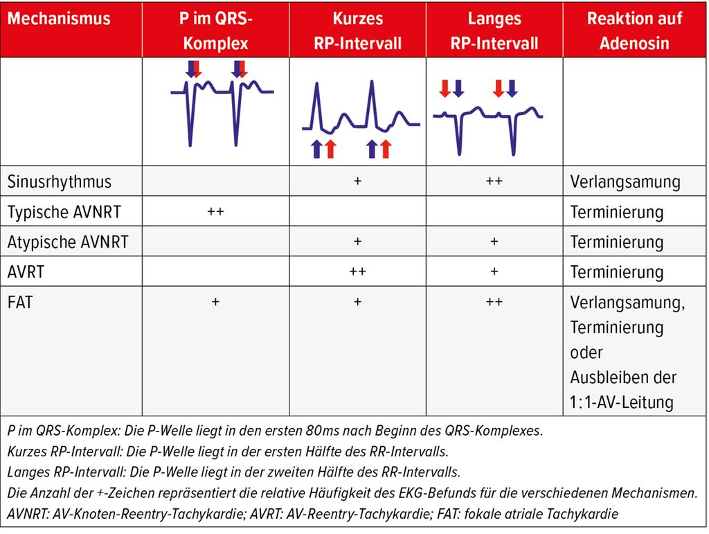 Supraventrikuläre Tachykardien - Kardiologie & Gefässmedizin ...