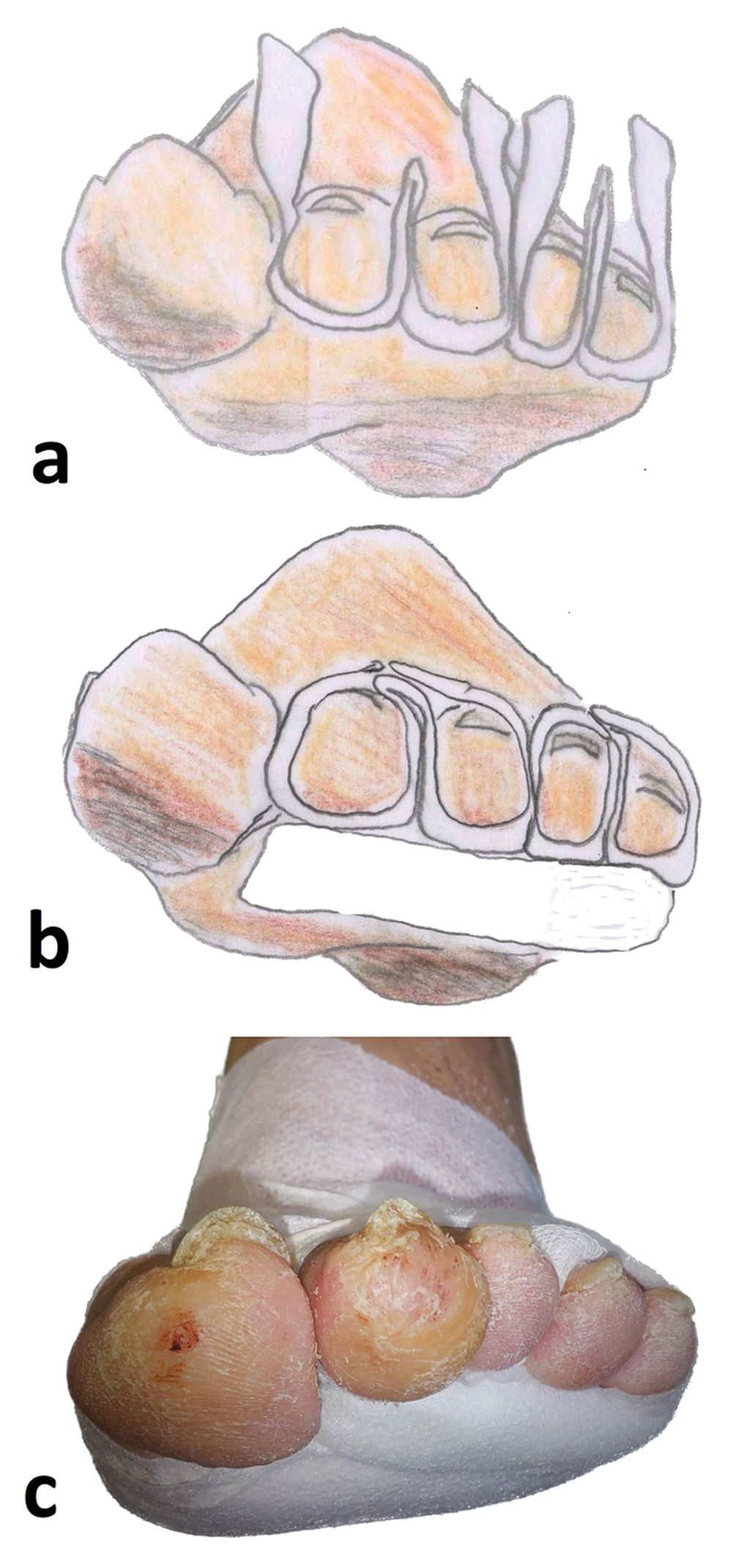 Kleine Chirurgie mit großer Wirkung beim diabetischen Fußsyndrom ...