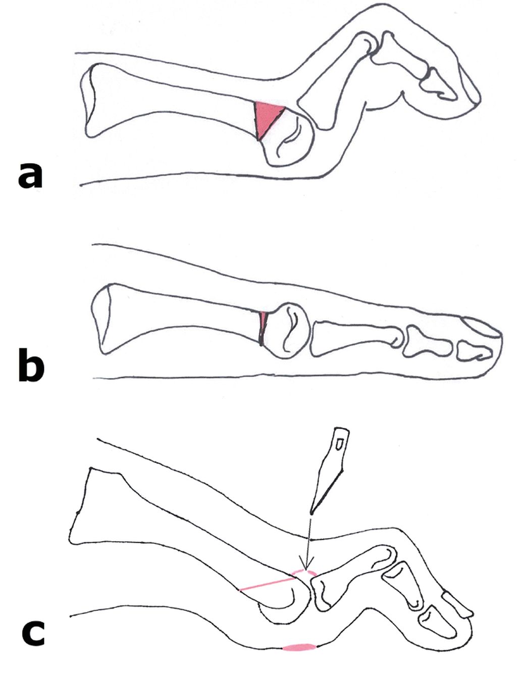 Kleine Chirurgie mit großer Wirkung beim diabetischen Fußsyndrom ...