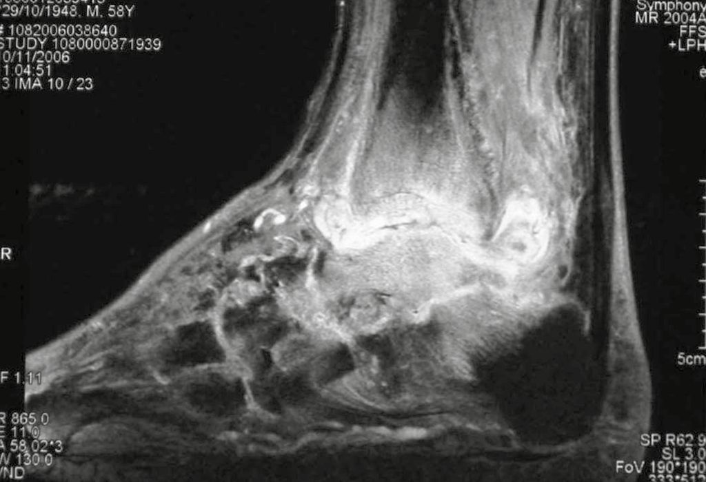 Der Charcot-Fuß als Sonderform des diabetischen Fußsyndroms ...