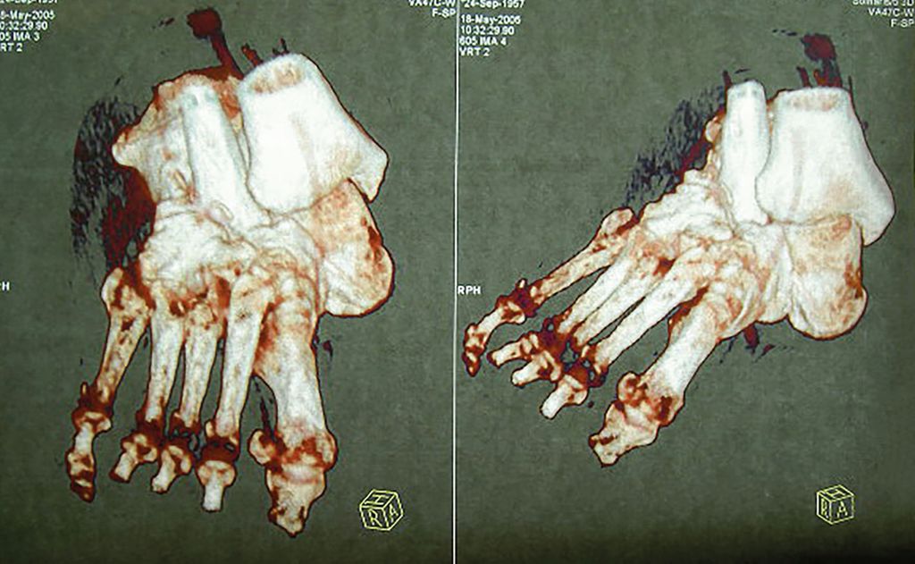 Der Charcot-Fuß als Sonderform des diabetischen Fußsyndroms ...