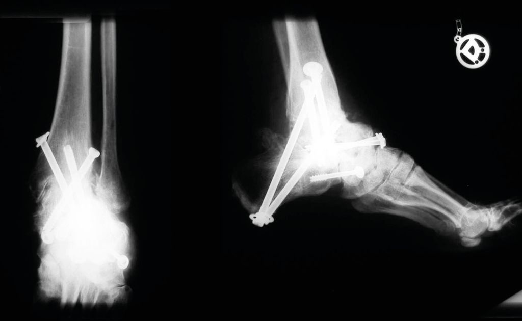 Der Charcot-Fuß als Sonderform des diabetischen Fußsyndroms ...