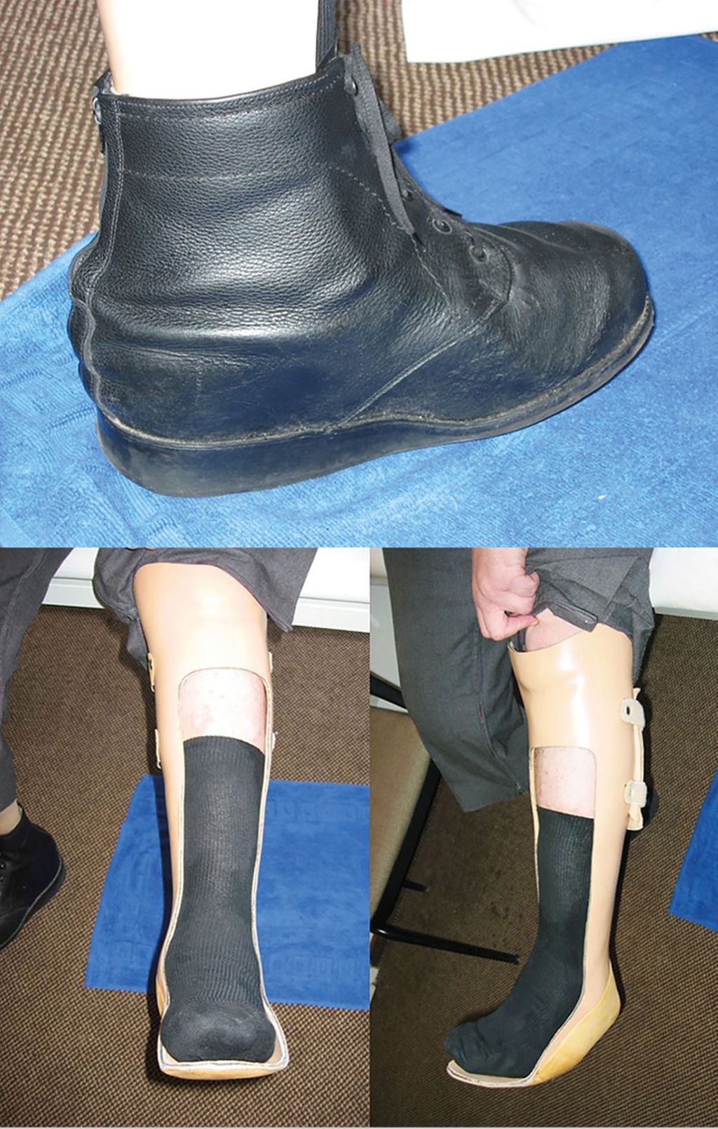 Der Charcot-Fuß als Sonderform des diabetischen Fußsyndroms ...