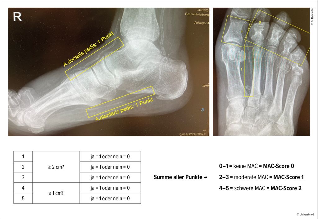 Ulkusabheilung: Prognoseabschätzung mit dem MAC-Score - Orthopädie ...