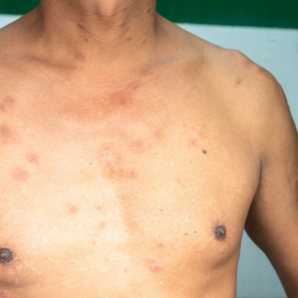 Néoplasme à cellules dendritiques plasmacytoïdes blastiques (BPDCN ...