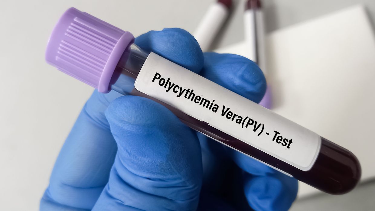 Polycythaemia vera – Aderlass ist out? - Hämatologie - Universimed ...